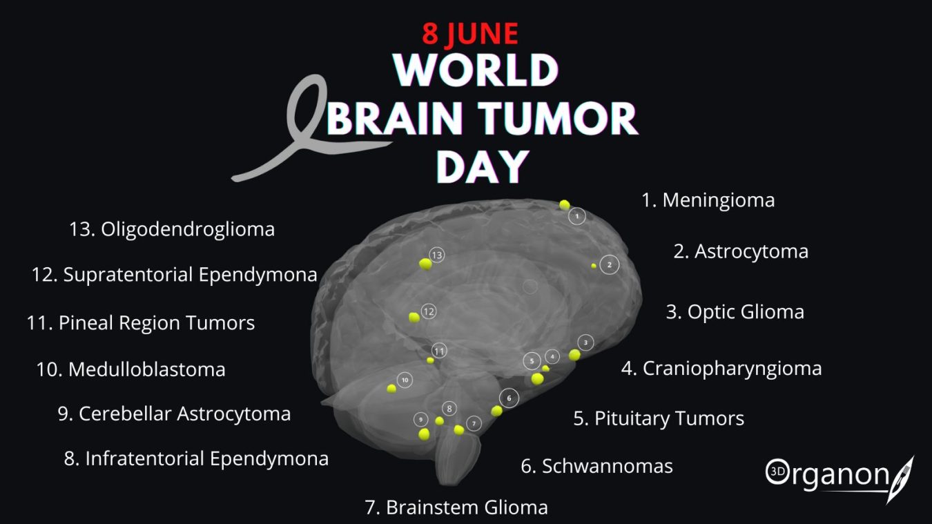 World Brain Tumor Awareness Day | 3D ORGANON